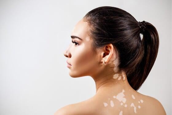 ¿Qué es el Vitíligo? | Cómo tratar el vitíligo